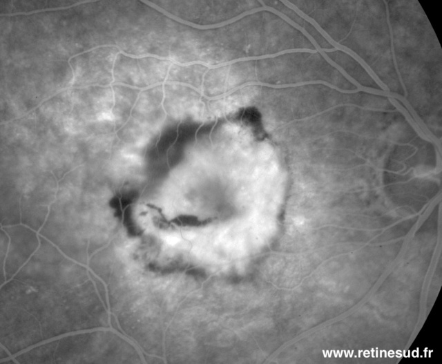 La DMLA -Retine SUD, centre d'ophtalmologie Montpellier