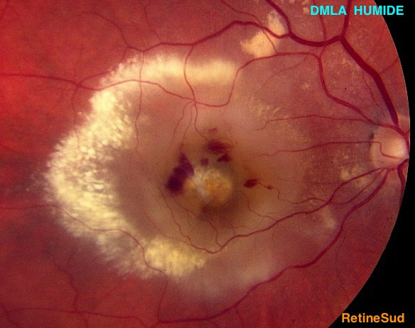 La DMLA -Retine SUD, centre d'ophtalmologie Montpellier