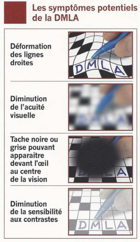 La DMLA -Retine SUD, centre d'ophtalmologie Montpellier