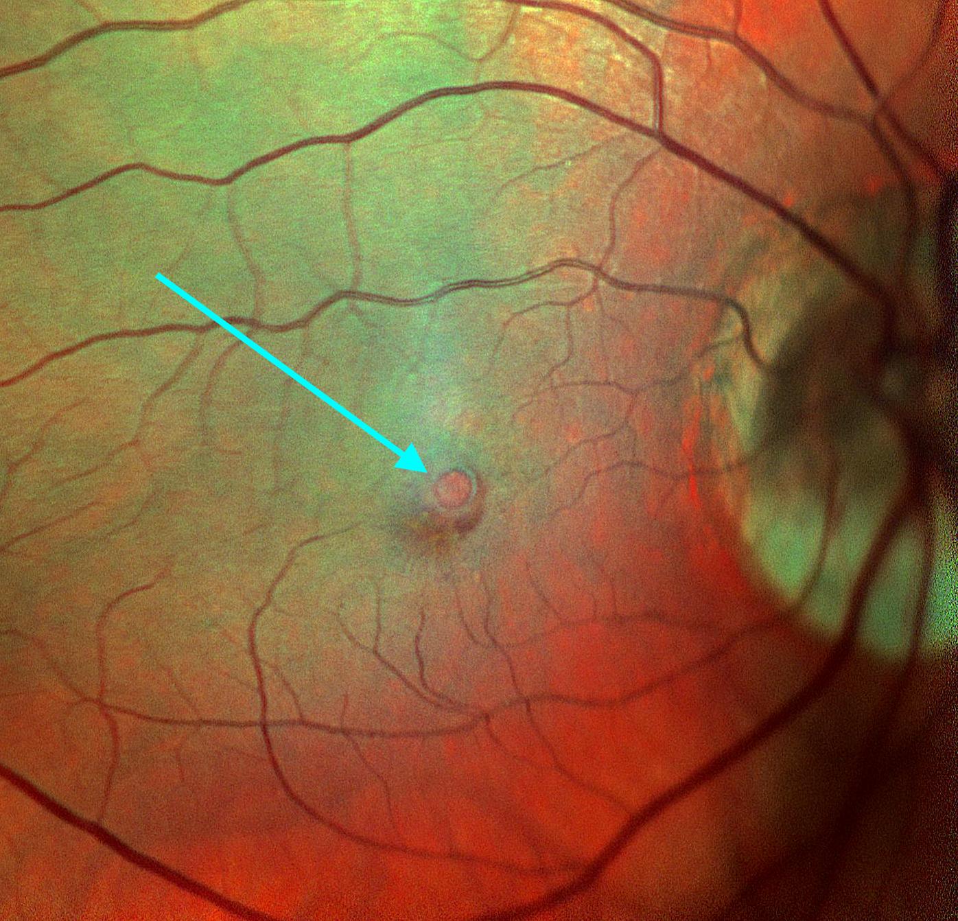 Le trou maculaire - Retine SUD, centre d'ophtalmologie Montpellier