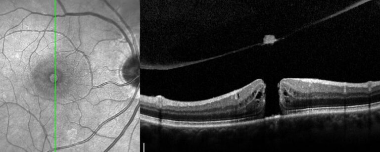 Le trou maculaire - Retine SUD, centre d'ophtalmologie Montpellier